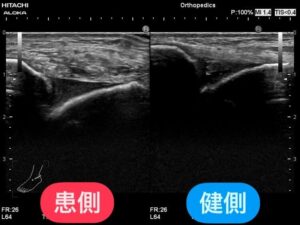 足関節捻挫（ATFL損傷） | 金子スポーツ接骨院
